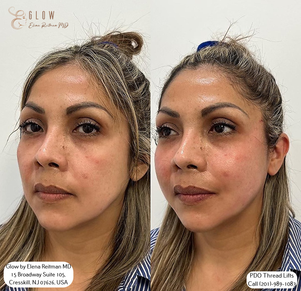 PDO Threadlift by Elena Reitman MD