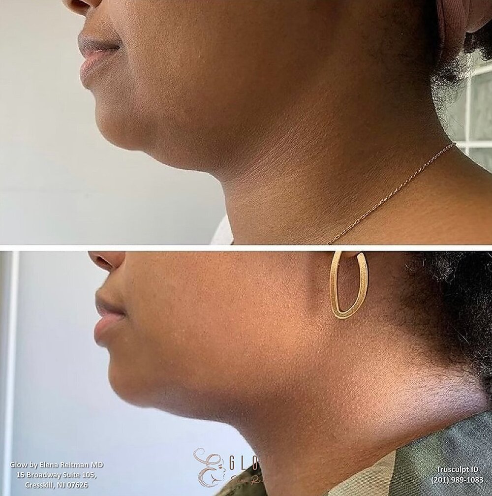 PDO Threadlift by Elena Reitman MD: Event post published to Glow by ...