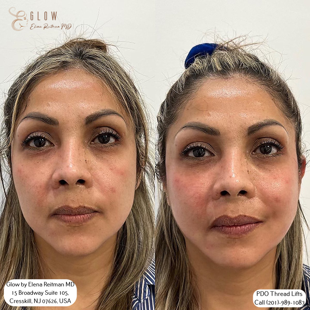 PDO Threadlift by Elena Reitman MD