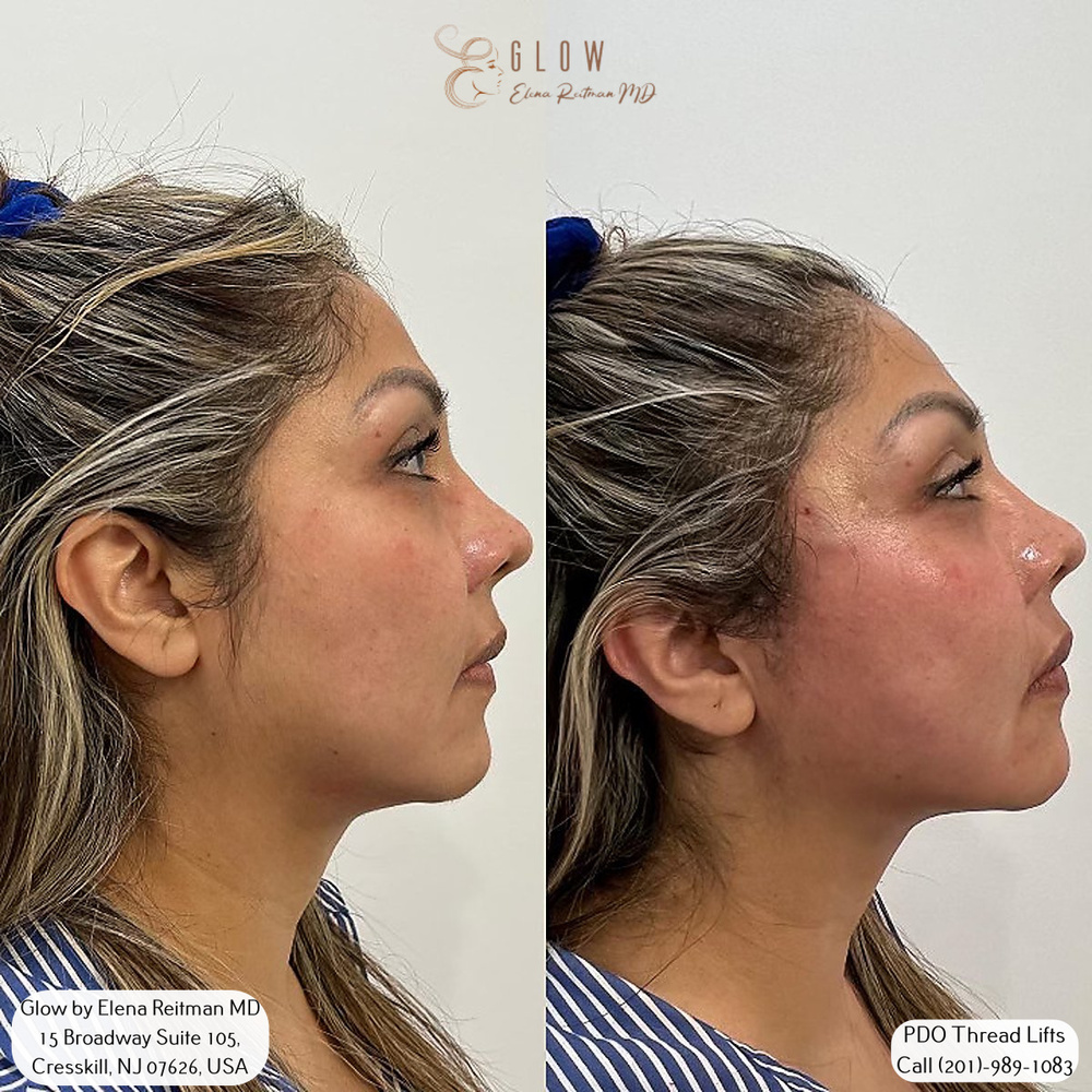 PDO Threadlift by Elena Reitman MD