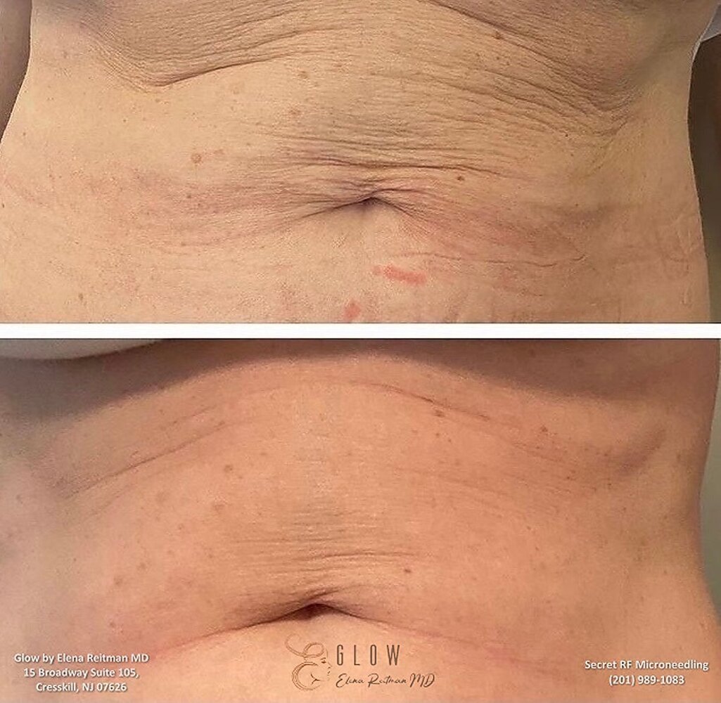 PDO Threadlift by Elena Reitman MD: Event post published to Glow by ...